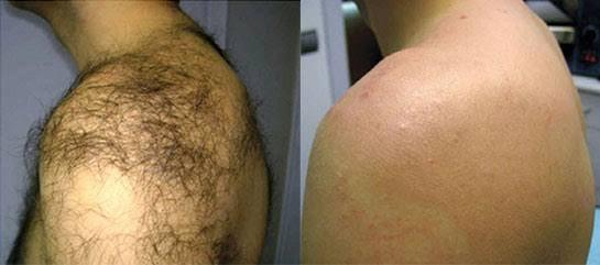 Can Laser Hair Removal Cause More Hair Growth Skinfudge Aesthetics 6129