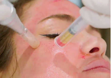 Micro needling vs Laser Resurfacing (CO2 Laser) – SKINFUDGE Aesthetics ...